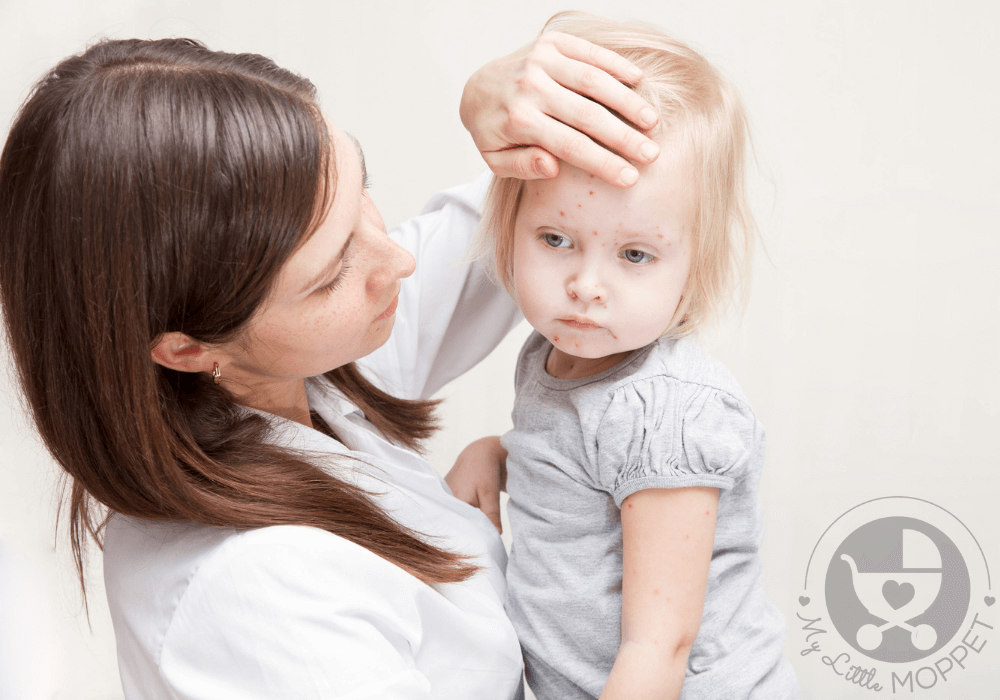 How to deal with Skin Rashes in Babies and Toddlers