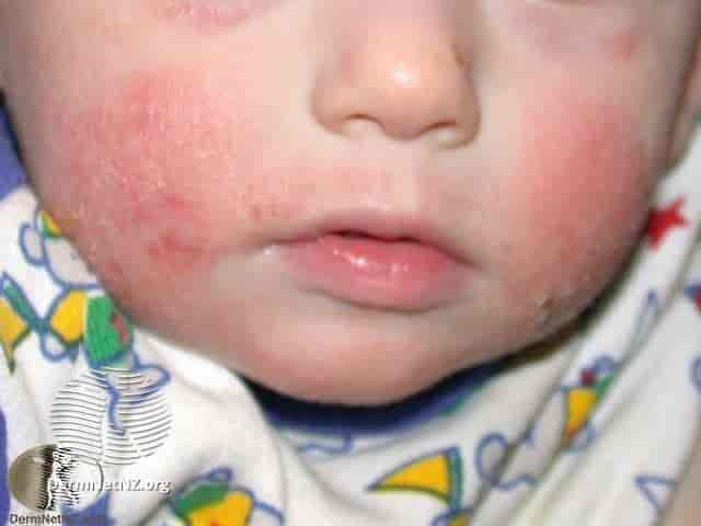12 Natural Remedies for Baby Eczema